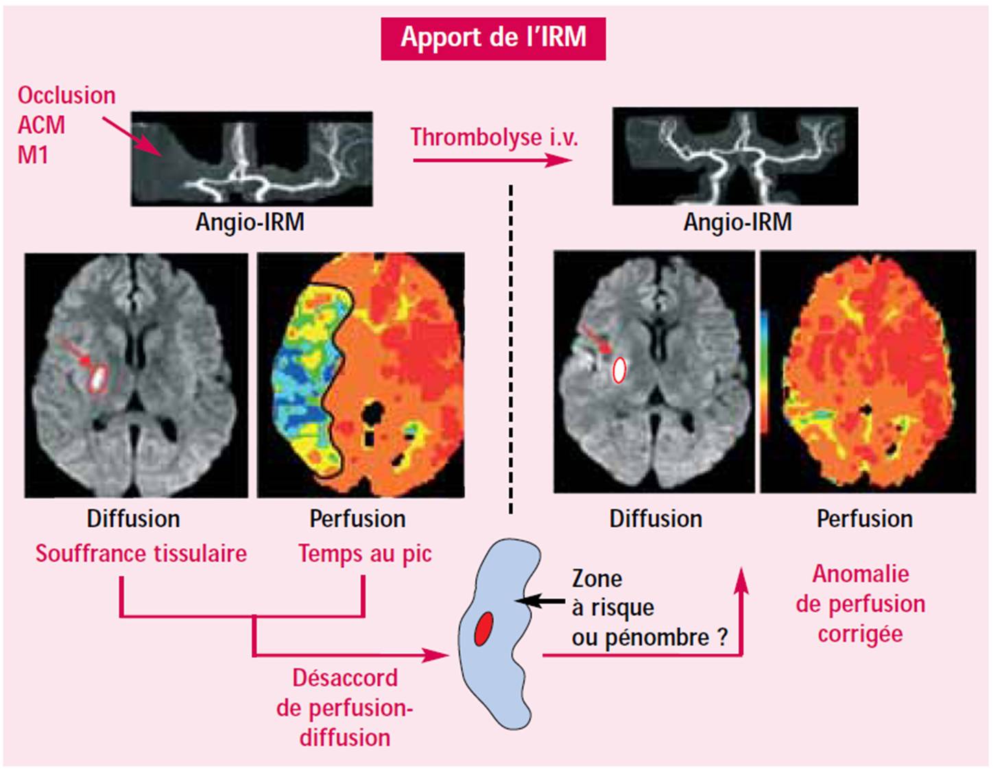 AVC : aspects cellulaires et moléculaires — Site des ressources d'ACCES ...
